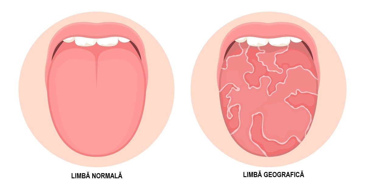 Limba geografică: cum arată, simptome, cauze și tratament