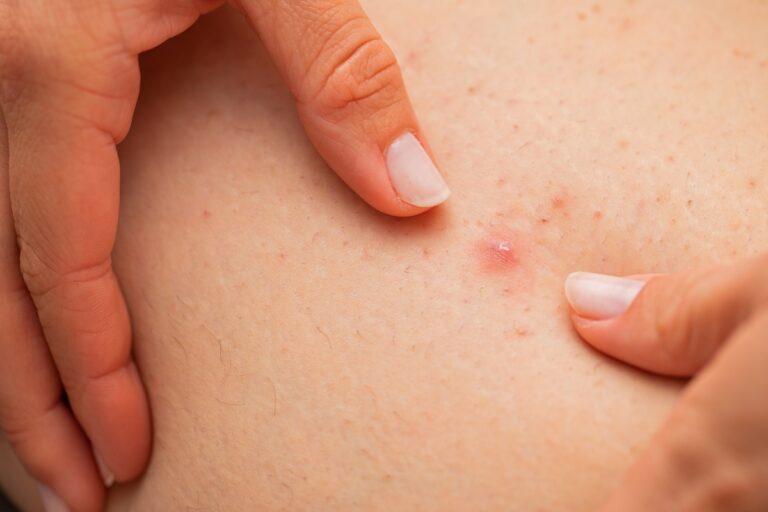 Foliculita: cauze, simptome, tratament și prevenție