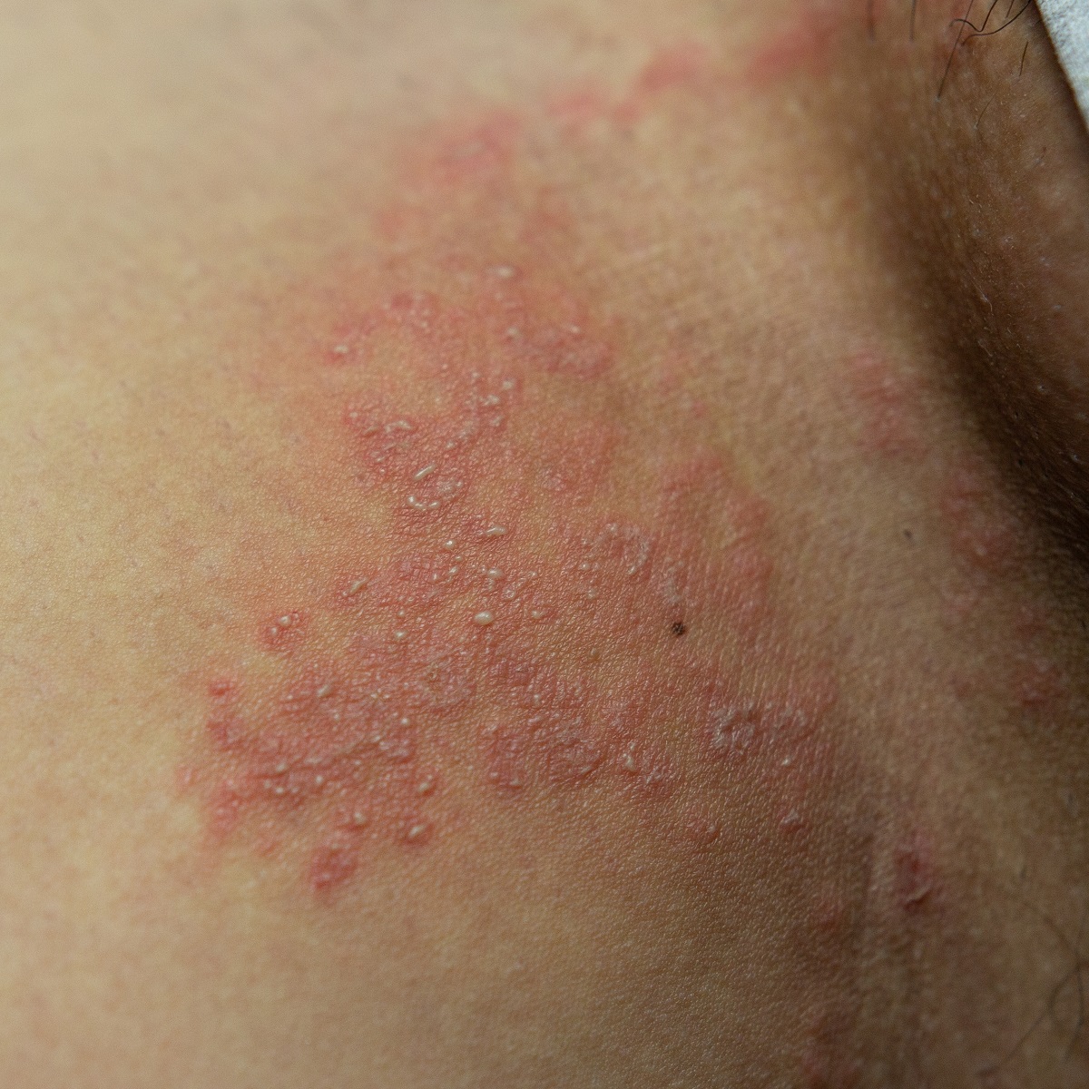 Tipuri de ciuperci care apar pe piele. Poze și recomandări